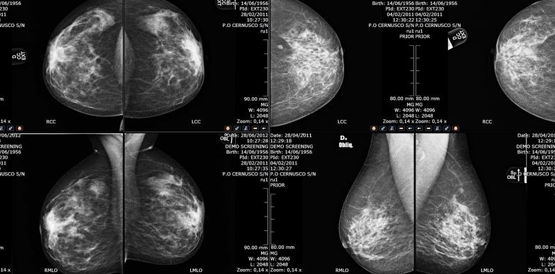 Mammographie | La plateforme des radiologues